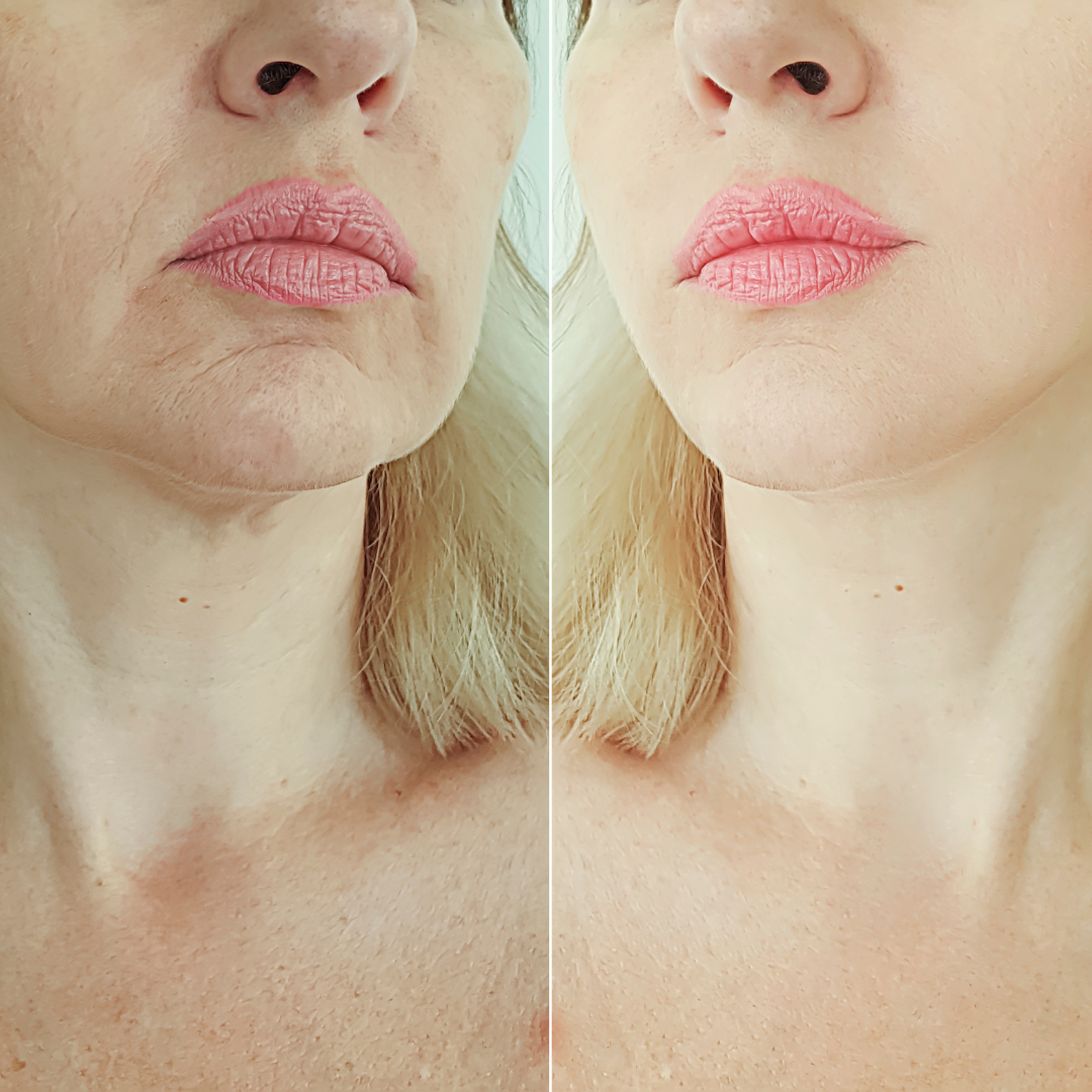 Micro Laser Peel - opteluxewellness