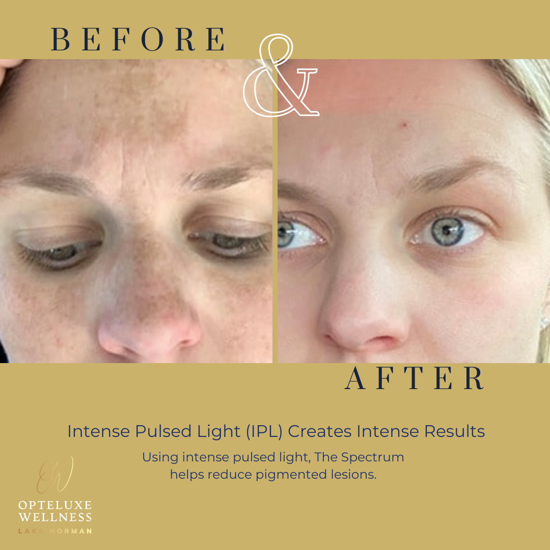 Intense Pulsed Light Laser (IPL) - opteluxewellness
