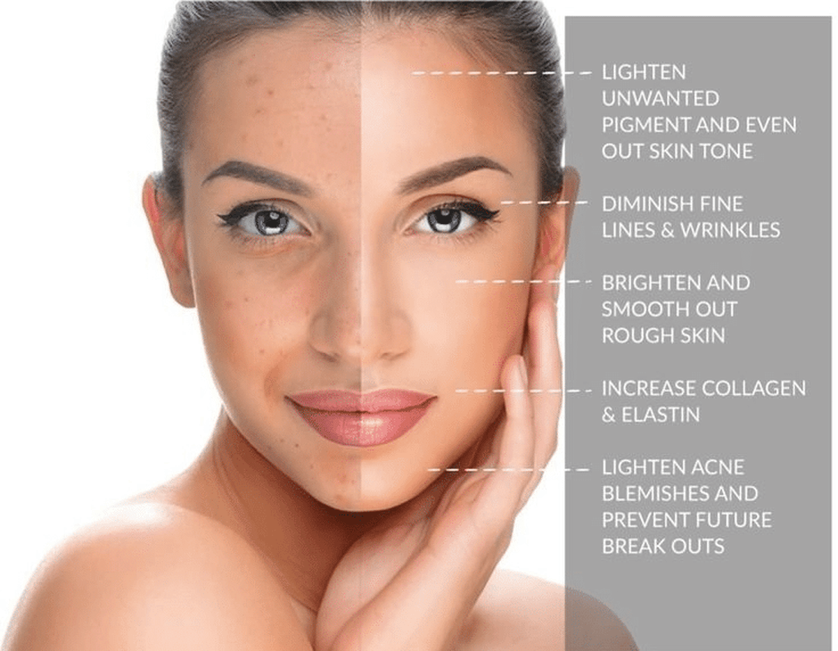 The Perfect Dermal Peel - opteluxewellness