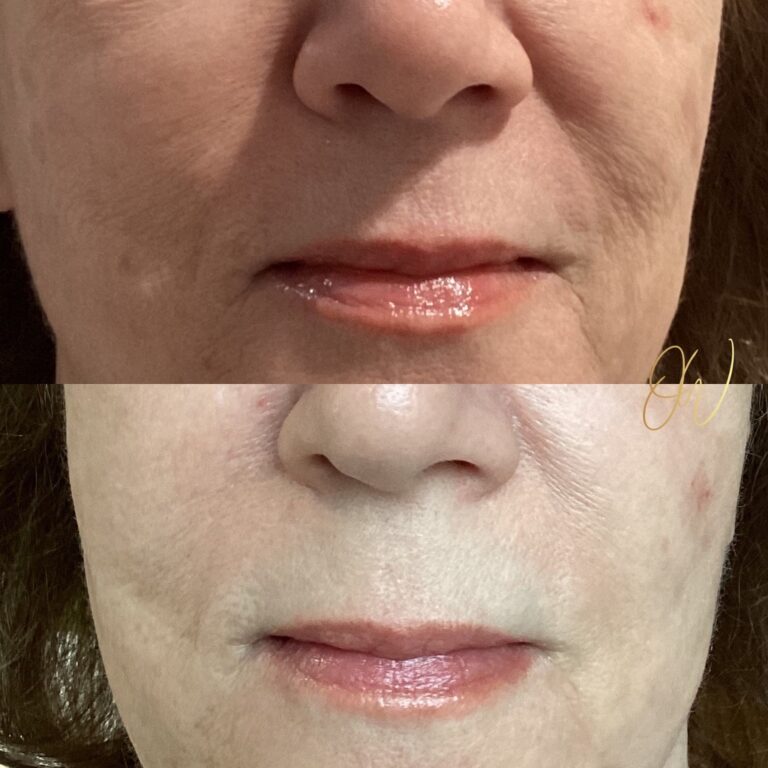 Pixel8 RF - opteluxewellness